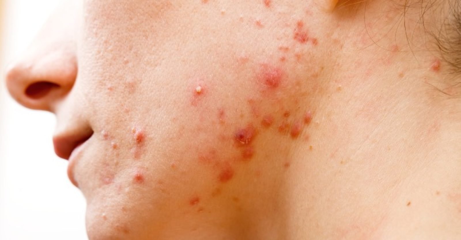 Cystic Acne Symptoms, Causes and 20 Natural Treatments - Well-Being Secrets