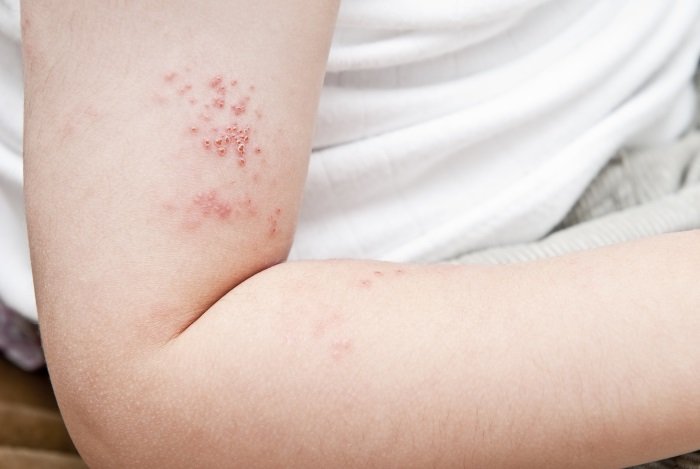 Shingles Symptoms, Causes, Risk Factors, and Natural Treatments - Well ...