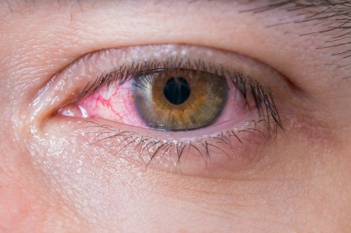 Pink Eye Symptoms, Treatments and Remedies - Well-Being Secrets