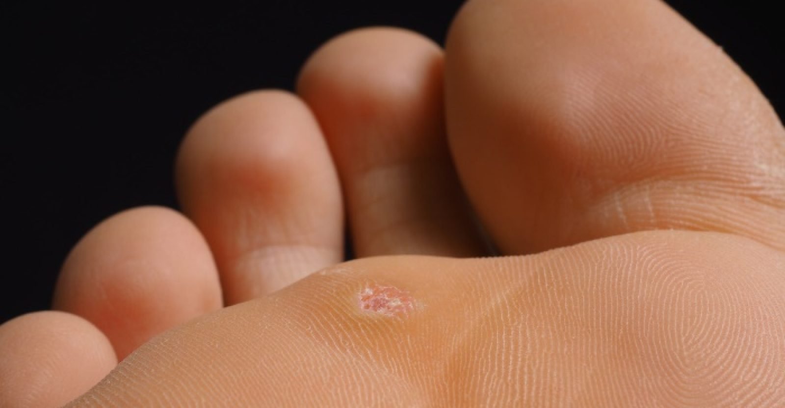 14 Plantar Wart Natural and Conventional Treatments - Well-Being Secrets